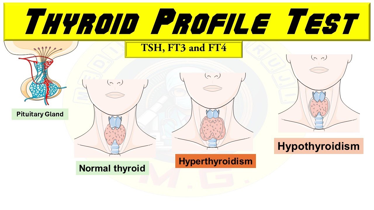 Thyroid Profile/Function Test Interpretation: TSH, Free T4 and Free T3 ...