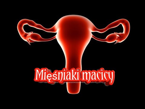 446. Mięśniaki Macicy  &  Co Zrobiliśmy ?