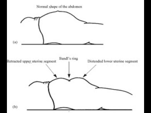 Retraction Ring - YouTube