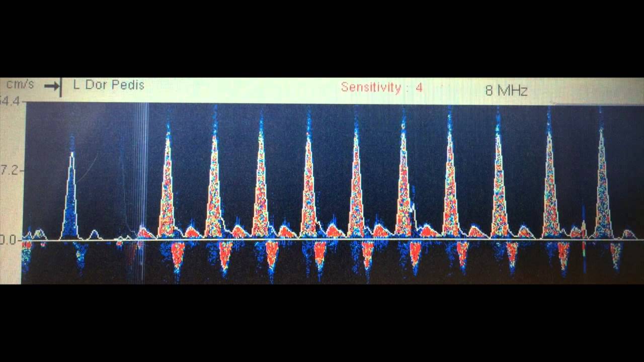 Triphasic Doppler Flow - YouTube
