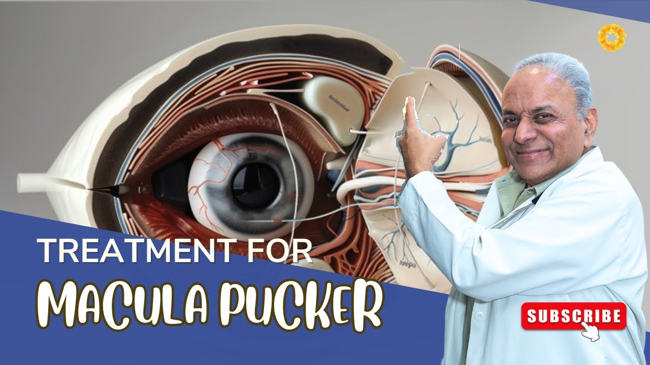 Macular Pucker Treatment | Non-Surgical Treatment for Retinal Problems ...