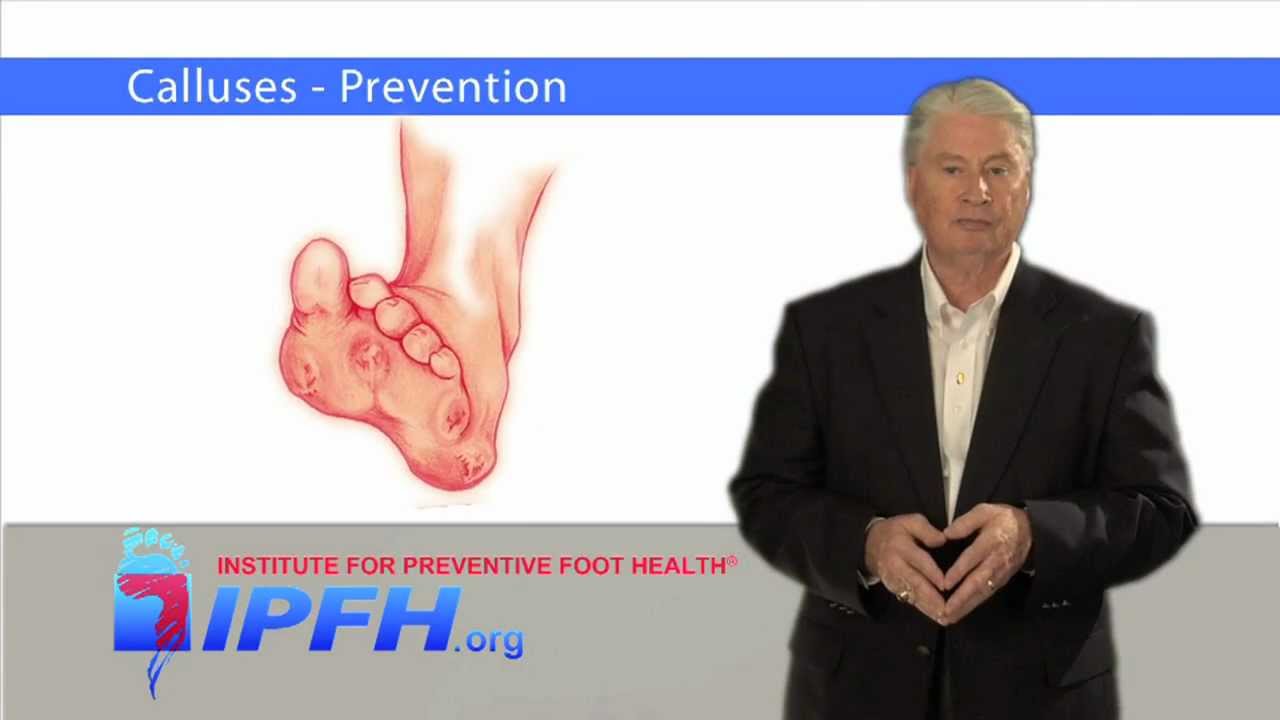 Calluses - Prevention - YouTube