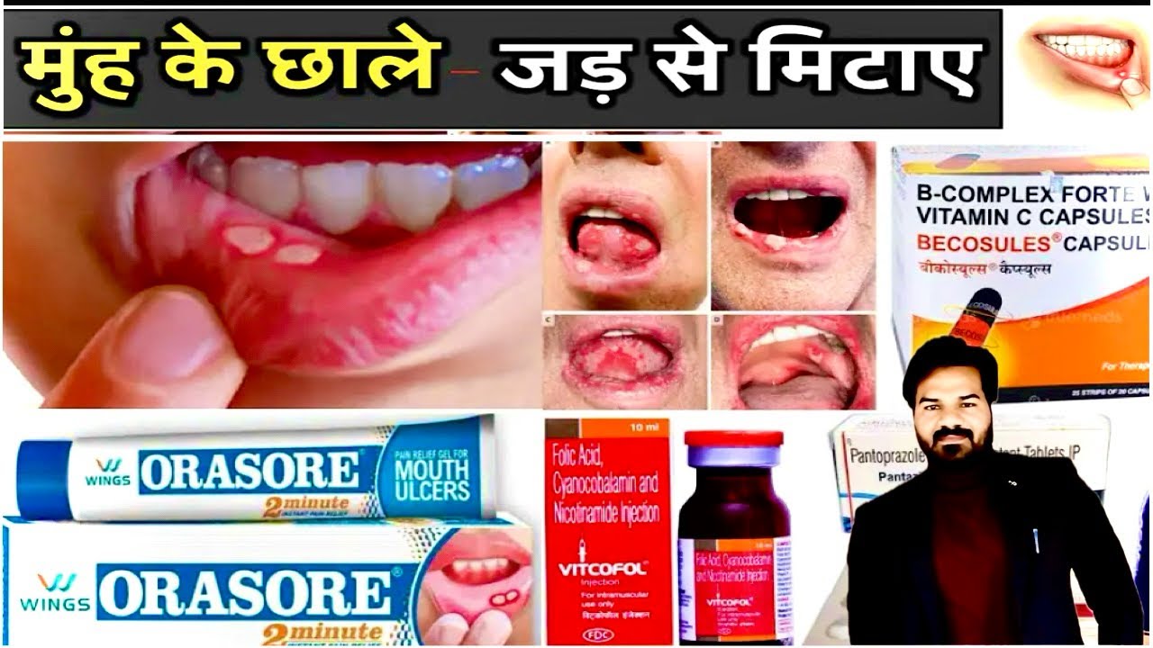 मुंह के छाले | Medicine | Mouth Ulcer | Ulcer Medicine | Pharmacy ...