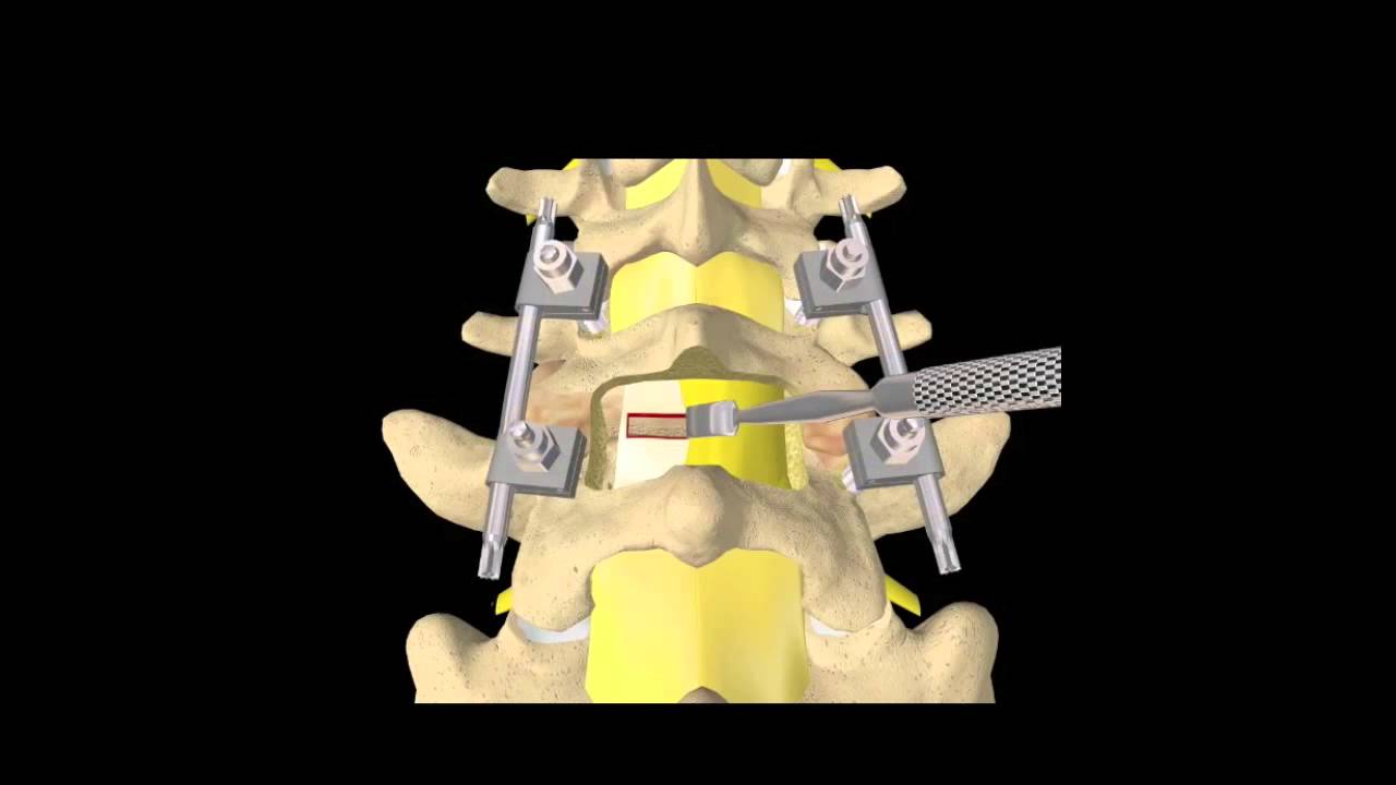 Artrodesi lombare con viti peduncolari e cage intersomatica - YouTube