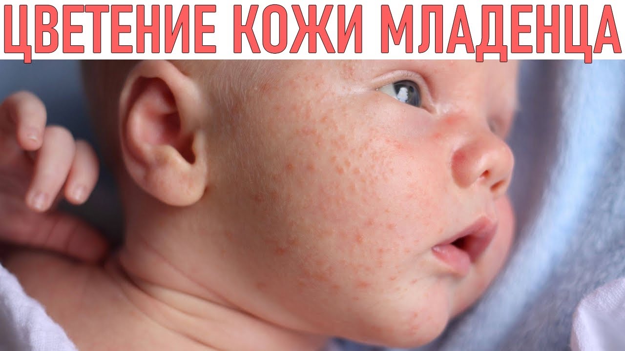 ЦВЕТЕНИЕ КОЖИ У НОВОРОЖДЕННЫХ Как ухаживать за кожей новорожденного