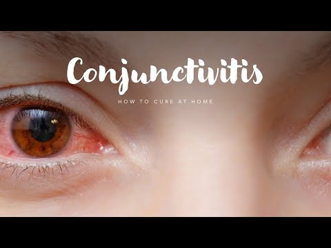 How to cure Conjunctivitis I how to heal an eye infection I how to ...