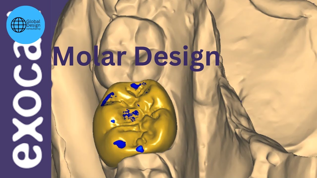 Molar Design Full Crown In हिंदी | Global Design Consultancy | exocad ...