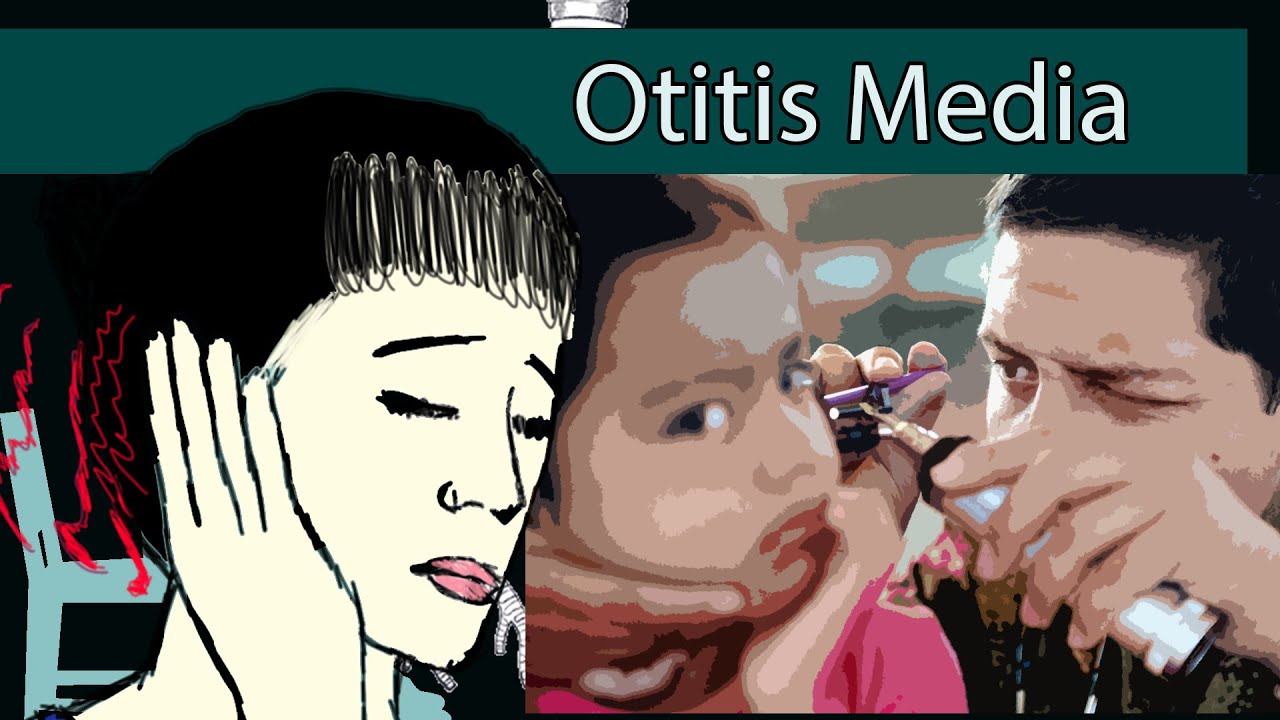 Otitis Media- Acute otitis media, Otitis media with effusion Symptoms ...