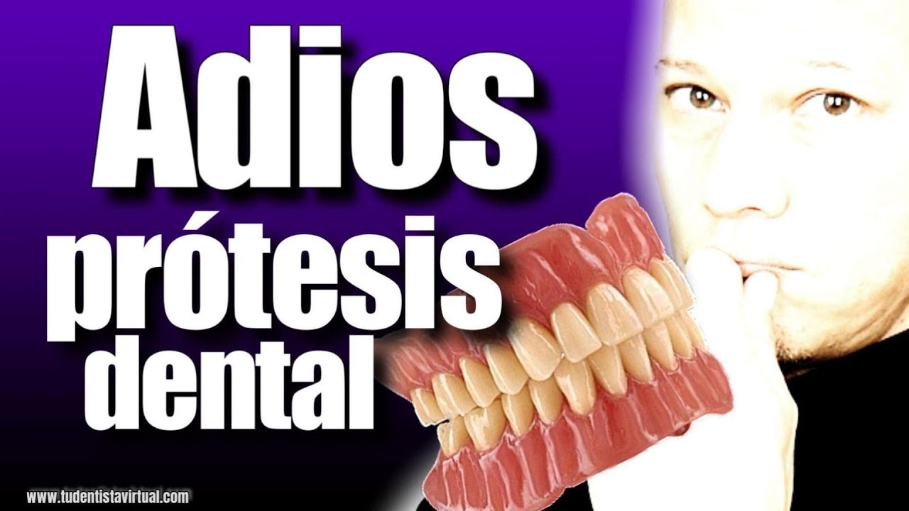 Como REEMPLAZAR TODOS los DIENTES aunque NO TENGAS mucho HUESO en las ...