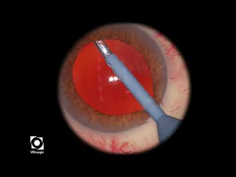 EyeSi CAT D Weak Zonules and Capsules Irrigation and Aspiration, Level ...