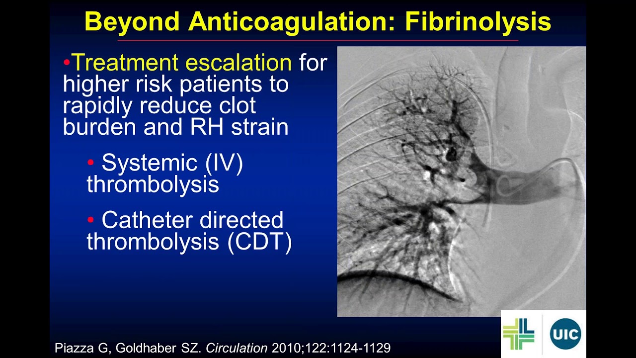 Sir Rfs Webinar 102417 Thrombolytic Therapy For Acute Pulmonary Embolism Youtube