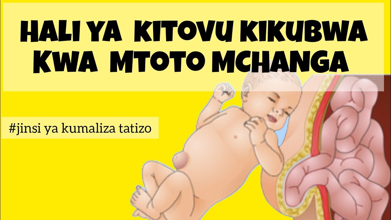 KITOVU KIKUBWA KWA MTOTO MCHANGA (umbilical hernia in children)/watoto ...