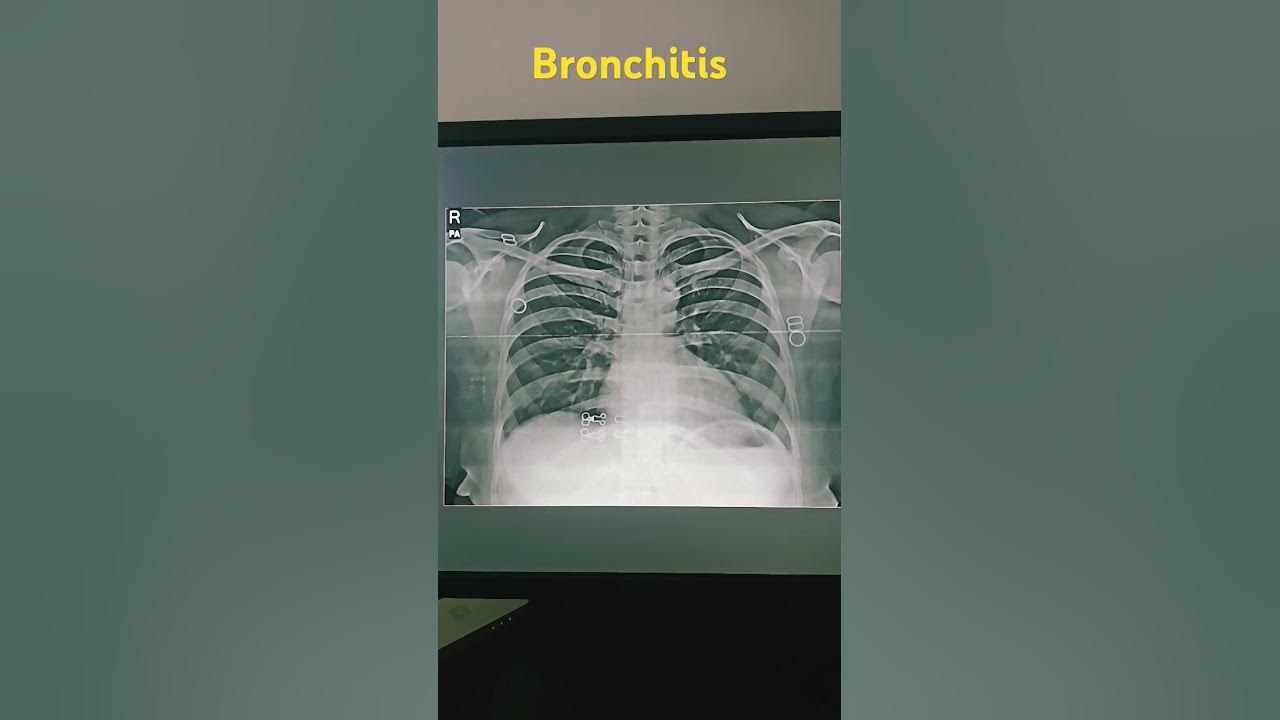 Xray Chest pa Bronchitis brancho vascular marking are prominent bhoth ...