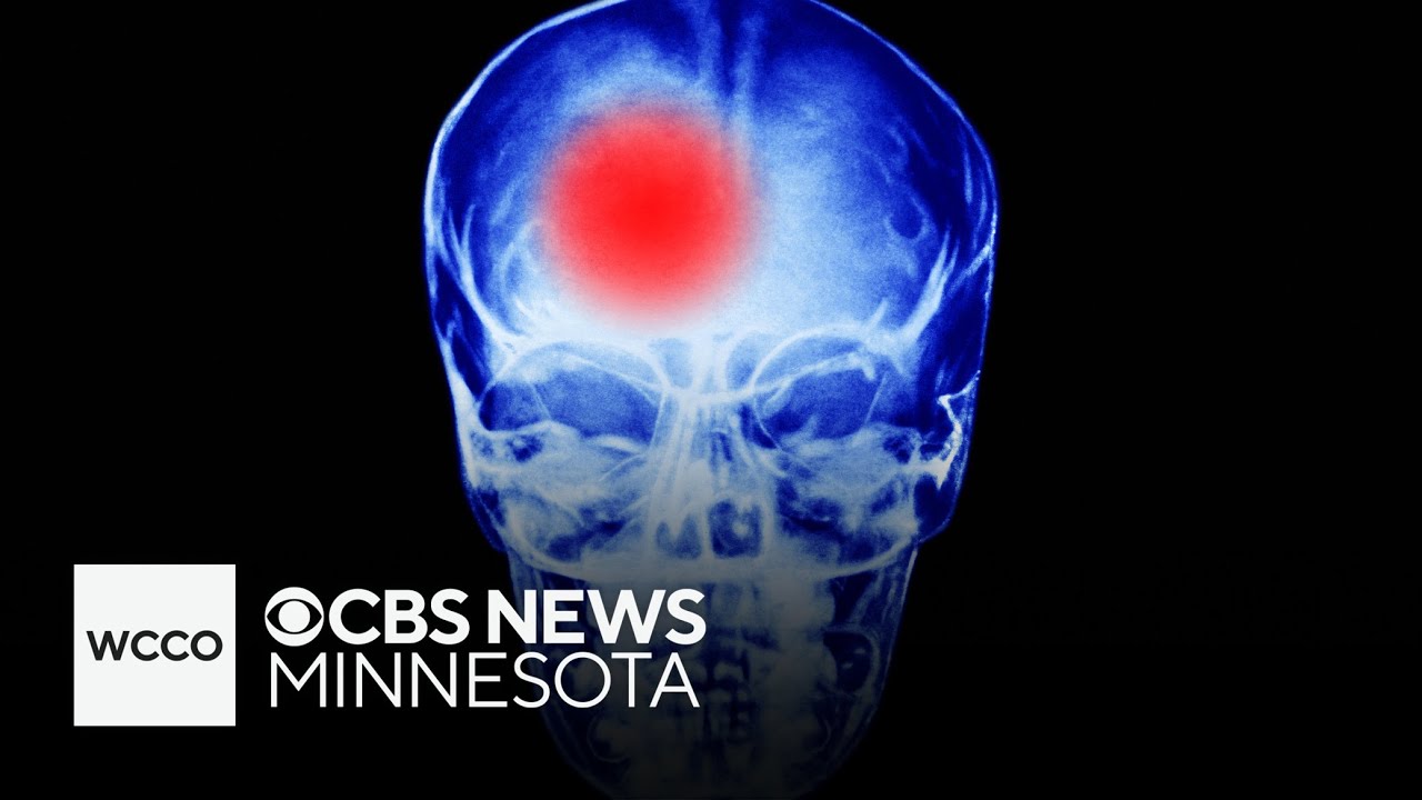 Know these key warnings signs for a stroke - YouTube