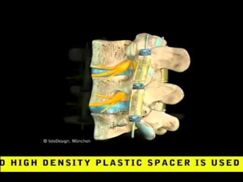 Dynamic stabilization technique - YouTube