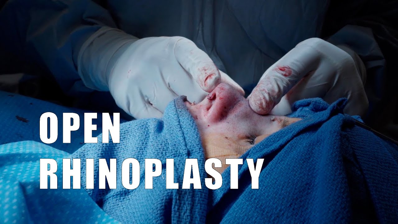 OPEN RHINOPLASTY | FULL SURGERY VIDEO - YouTube