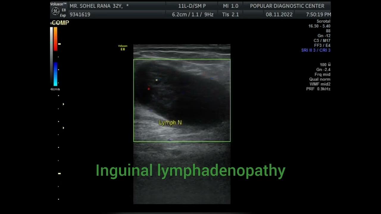 Inguinal Lymphadenopathy Youtube