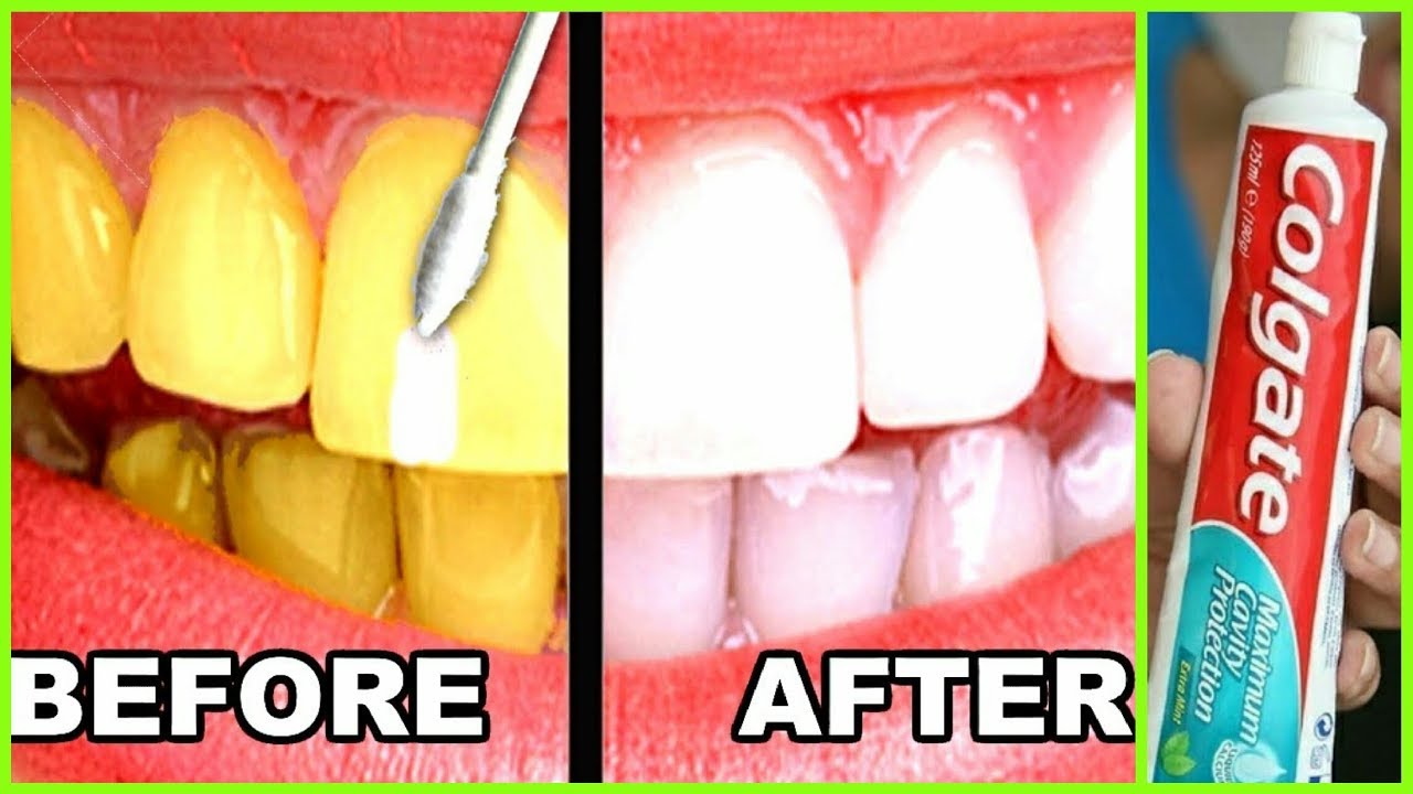 Teeth Whitening At Home In 3 Minutes || How To Whiten Your Yellow Teeth ...