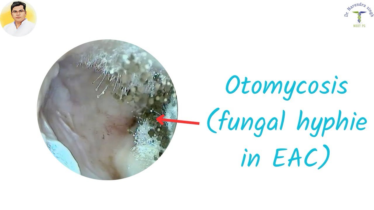 Unexpected Fungal growth Inside Ear / Otomycosis - YouTube