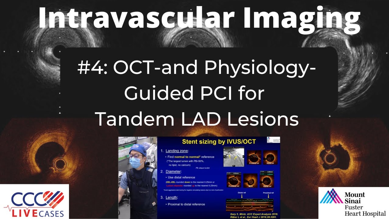 OCT-and Physiology-Guided PCI for Tandem LAD Lesions - YouTube
