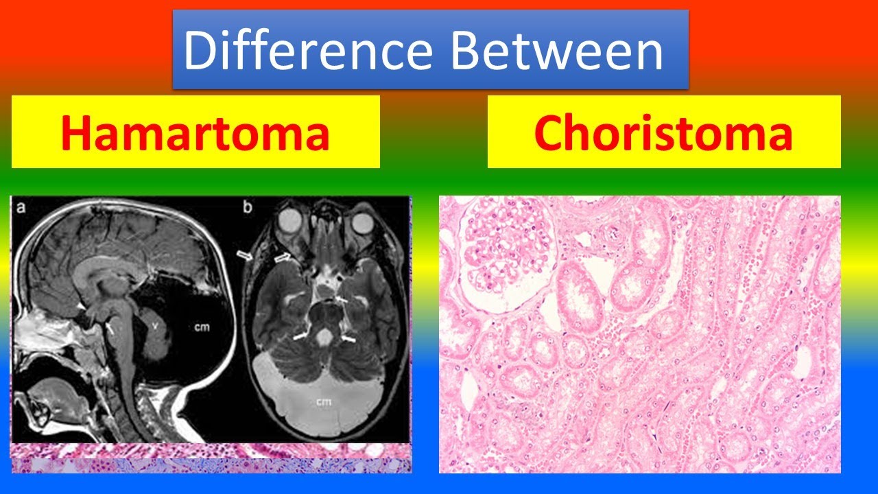Difference between Hamartoma and choristoma - YouTube