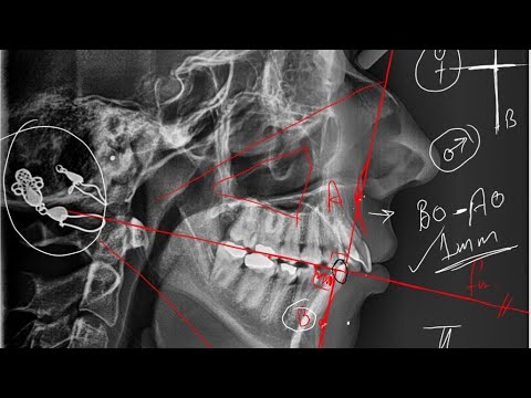 06- Utilization of Occlusal plane (Cephalometric analysis) - YouTube