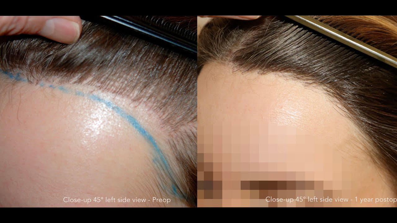 FUE Correction on 25-Year-Old Woman – Dr. Feriduni Fixes Failed Hair ...