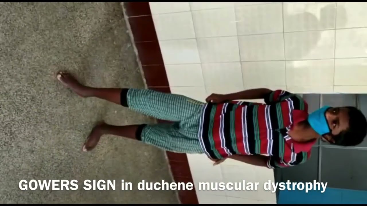GOWERS SIGN IN DUCHENNE MUSCULAR DYSTROPHY - YouTube