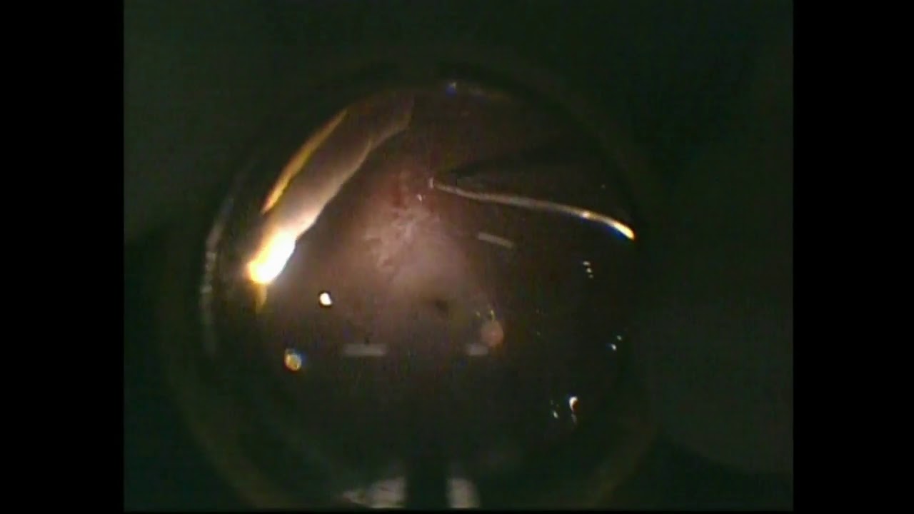 (Tractional Retinal Detachment (TRD - YouTube