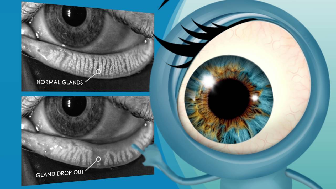 Dry Eye or MGD Doc by Tear Science - YouTube
