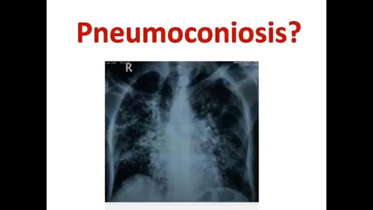 Pneumoconiosis on Chest X-Ray and CT Scan Chest - YouTube