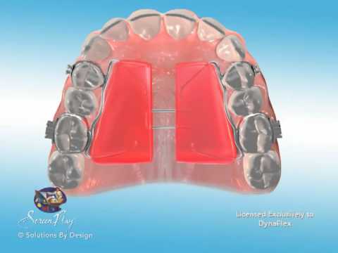 DynaFlex MAX 2000 - YouTube