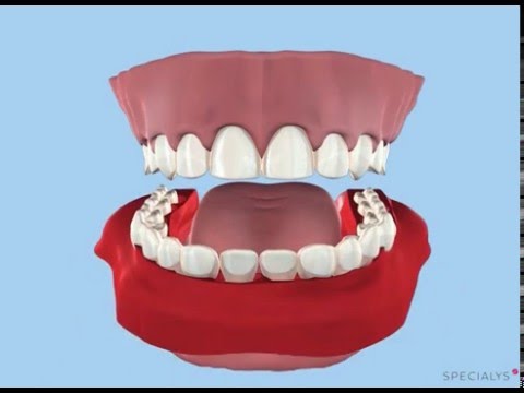 Prothèse adjointe complète mandibulaire - YouTube