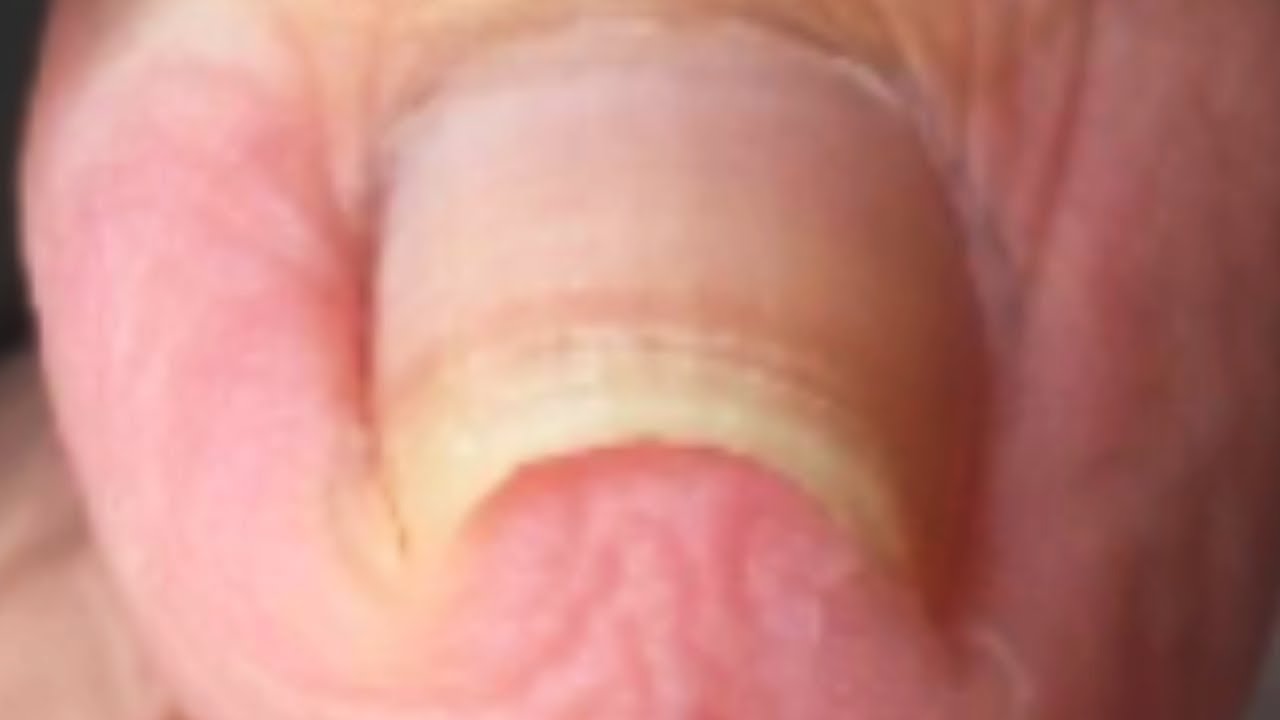 Toenails Are Curled And Trimmed Silkily! - YouTube