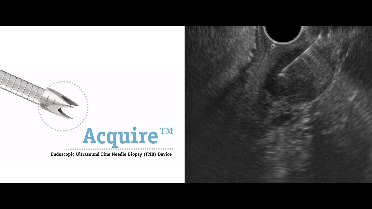 EUS-FNB of a gastric GIST with Boston Acquire 22G - YouTube