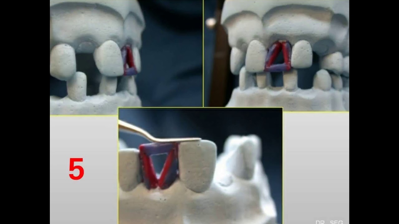Paso a paso encerado de dientes anteriores - YouTube