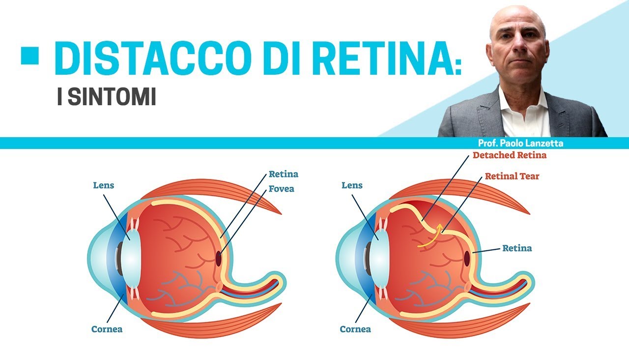 DISTACCO DI RETINA: i sintomi | ForumSalute - YouTube