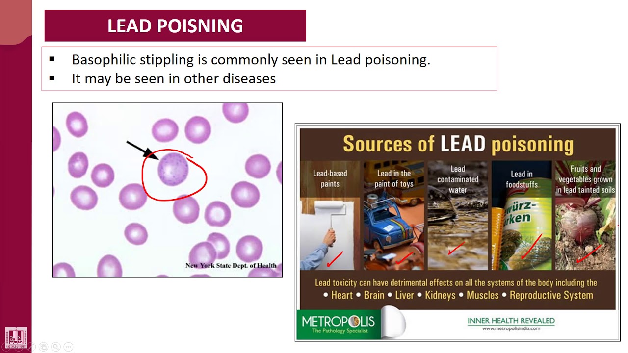 Hematology - 1 | U8-L5 | Lead poisoning - YouTube