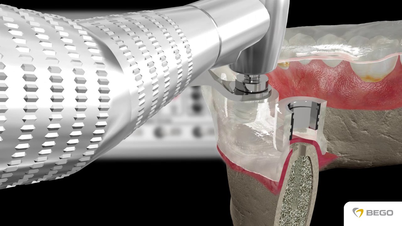 Протокол навигационной хирургии BEGO Guide S-Line - YouTube