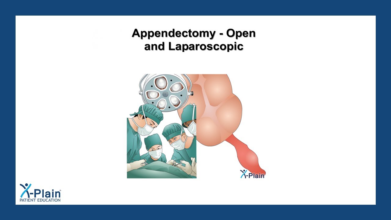 Appendectomy - Open and Laparoscopic - YouTube