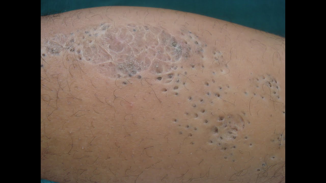 Nevus Comedonicus A Rare Skin Disease - YouTube