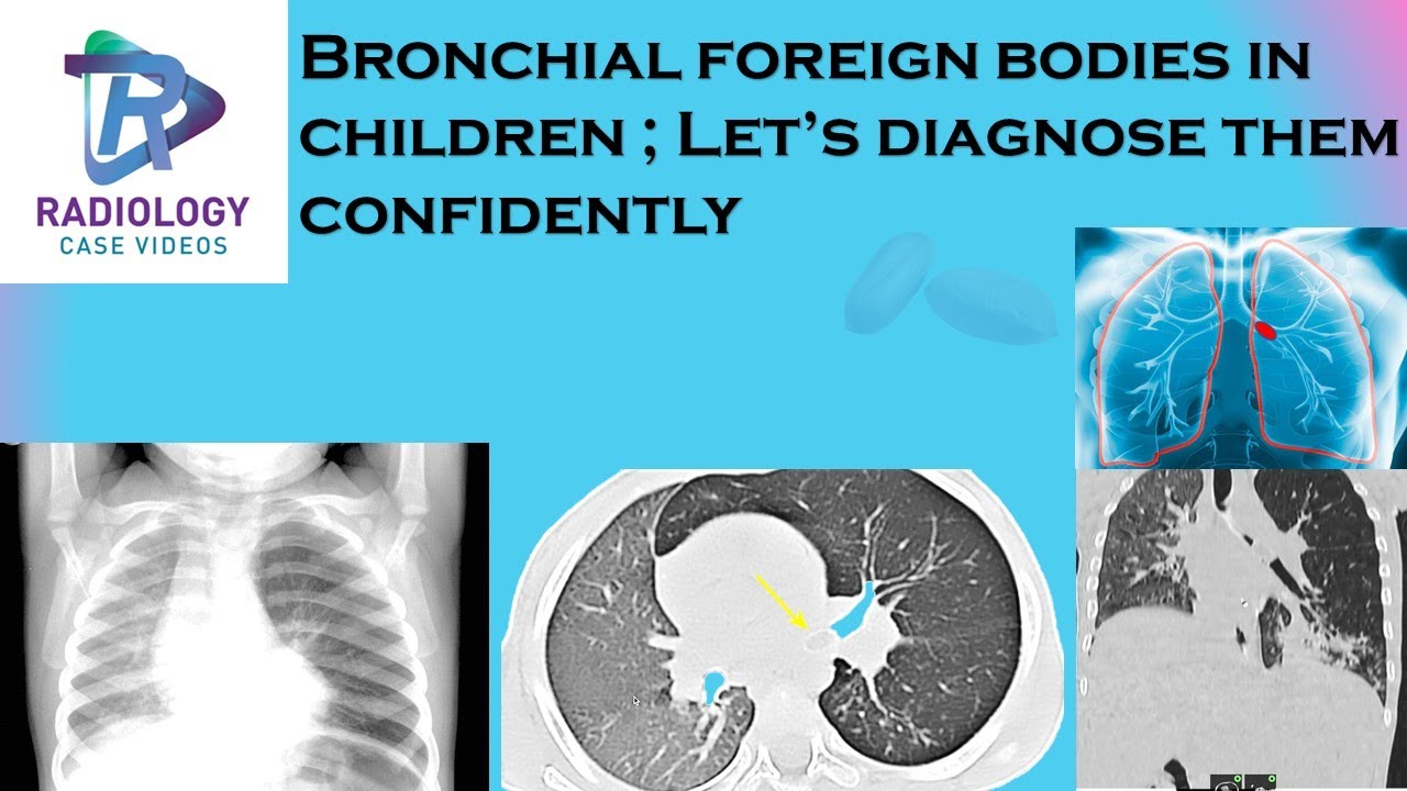 Bronchial foreign bodies in children# Unilateral hyperlucent lung#Lung ...