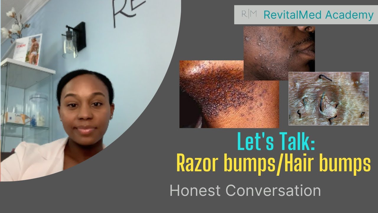 Let's talk: Ingrown hairs/PFB/Razor bumps- Honest conversation - YouTube