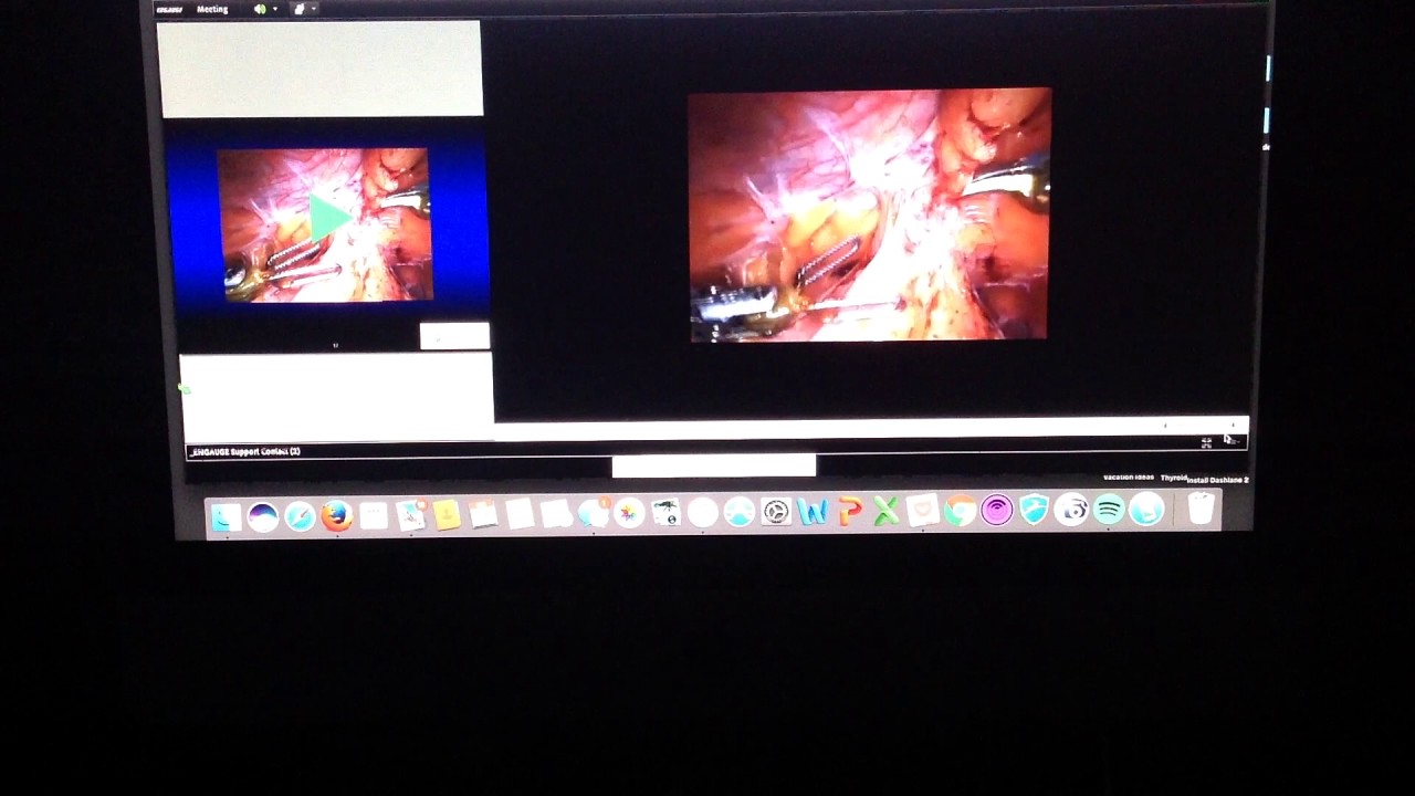 Yuri Novitsky. Feb 2017 Modern Techniques in Hernia Repair - YouTube