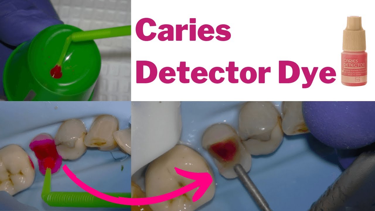 Caries Detection Dyes Springerlink 42 Off