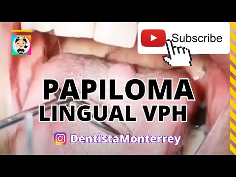 VPH👅Papiloma Lingual Causas - YouTube