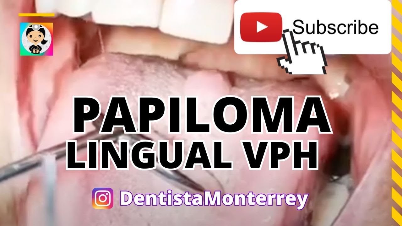 VIRUS DEL PAPILOMA HUANO VPH👅PAPILOMA LINGUAL CAUSAS - YouTube
