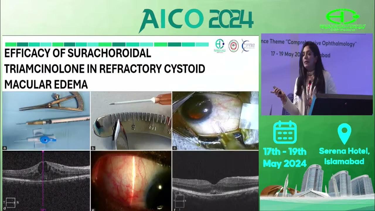 3rd Best Paper-AICO 2024-Suprachoroidal Triamcinolone In Refractory Cases of Cystoid Macular ...
