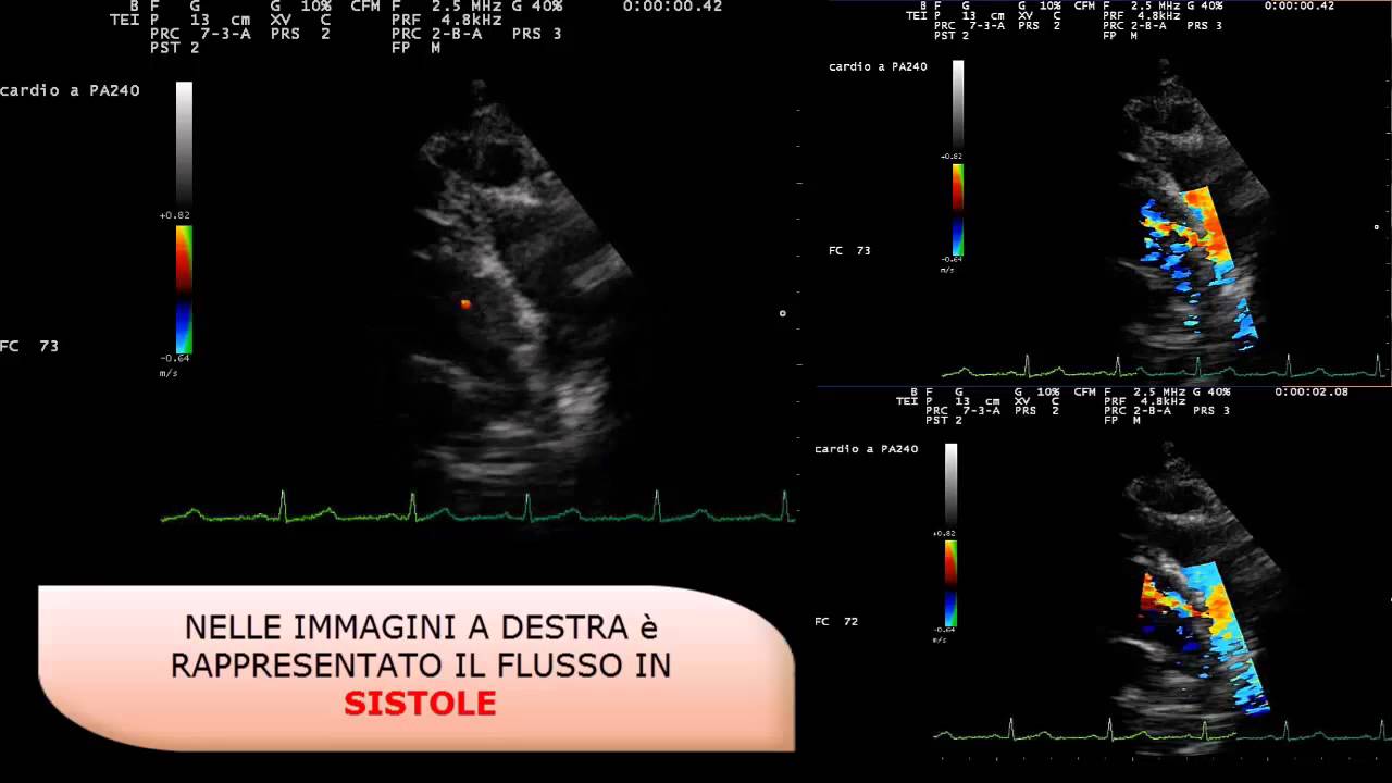 DOTTO DI BOTALLO PERVIO - YouTube