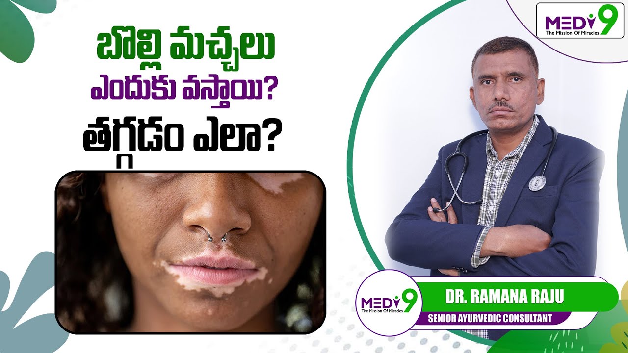 White Patches on Skin | Symptoms of Vitiligo Disease (Bolli Machalu ...